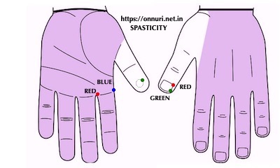 Insight into acupuncture for spasticity – ONNURI